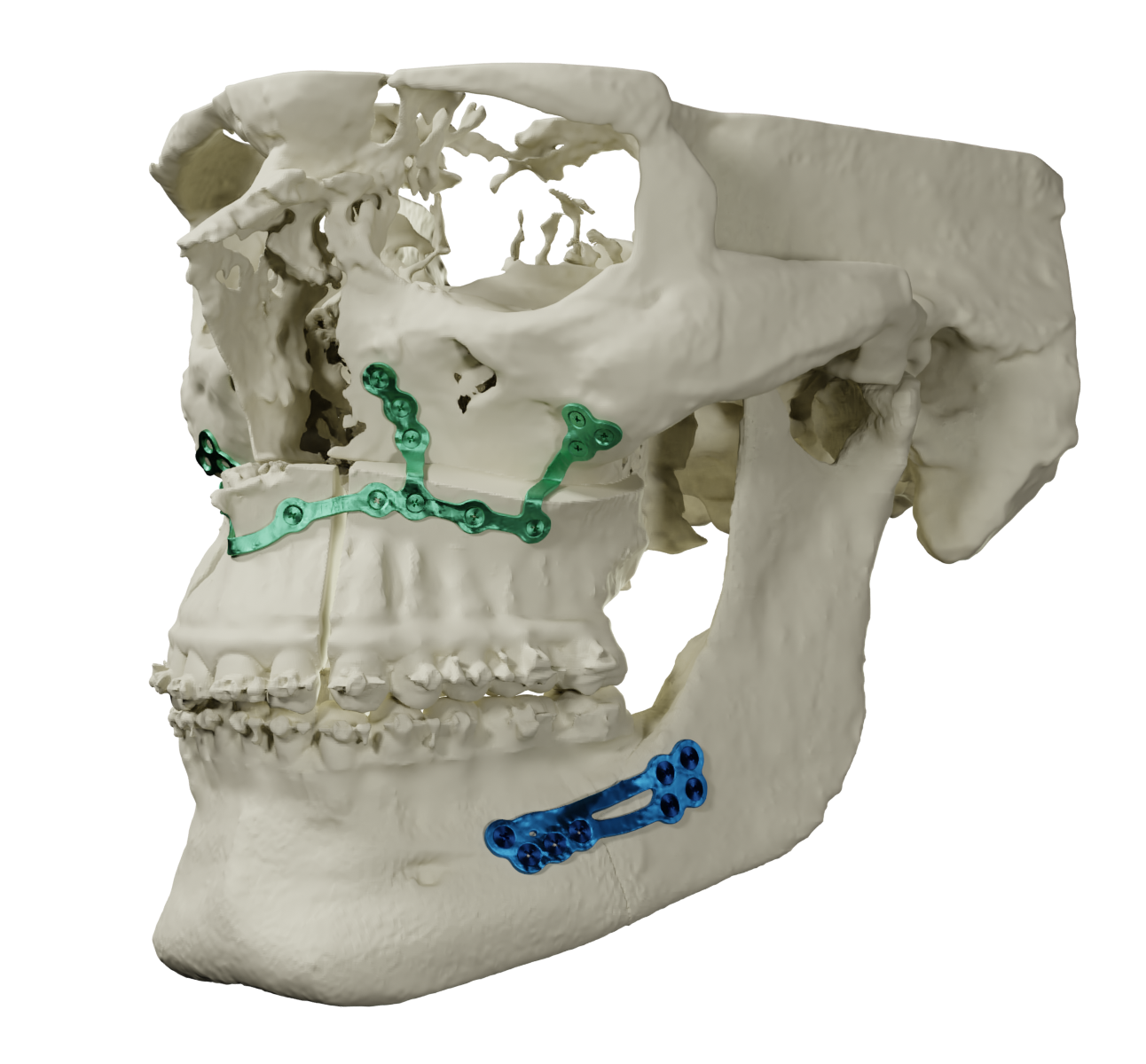 Custom Medical Solutions - MedCAD