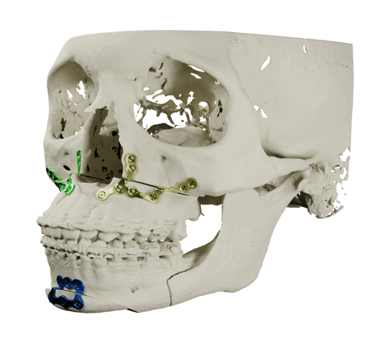 Custom Medical Solutions - MedCAD